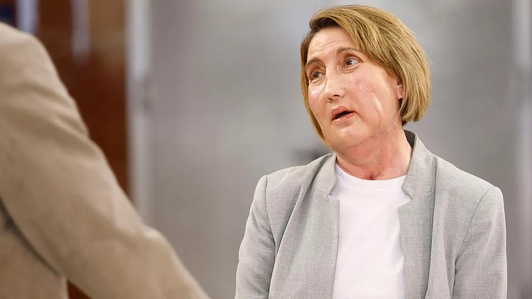 Verity - Woman Receives First Face Transplant from Euthanized Donor